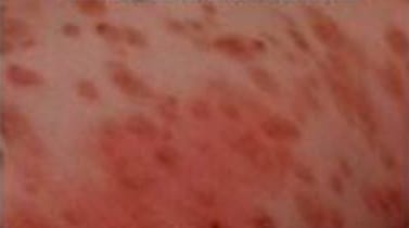About MCD - The UK Mastocytosis Support Group
